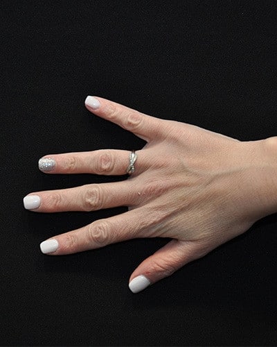 Hand Rejuvenation in Atlanta GA | Beaty Facial Plastic Surgery