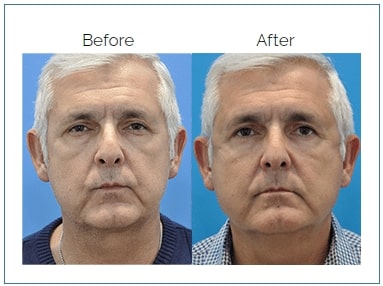 For Men - Beaty Facial PlaFacial Plastic Surgery For Men Atlanta ...