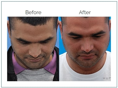 For Men - Beaty Facial PlaFacial Plastic Surgery For Men Atlanta ...