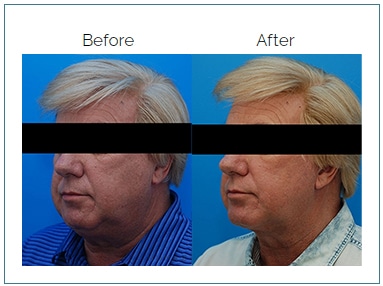 For Men - Beaty Facial PlaFacial Plastic Surgery For Men Atlanta ...