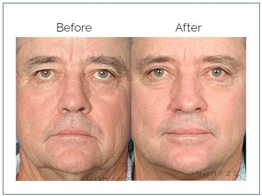 For Men - Beaty Facial PlaFacial Plastic Surgery For Men Atlanta ...