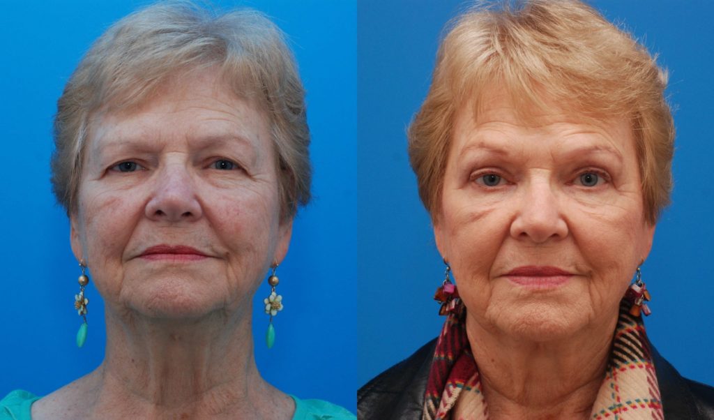 Facial Plastic Surgery Procedures Atlanta Alpharetta GA