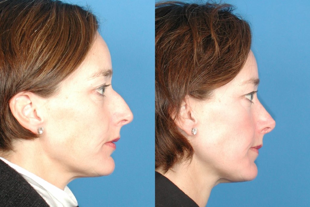 Facial Plastic Surgery Procedures Atlanta Alpharetta GA