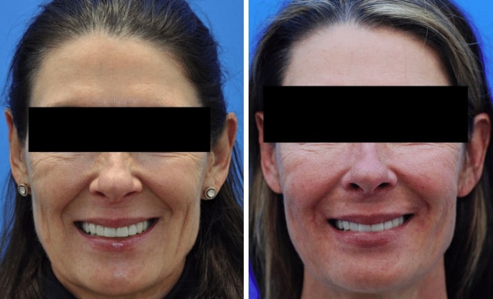 Injectable Filler By Area Atlanta Alpharetta GA