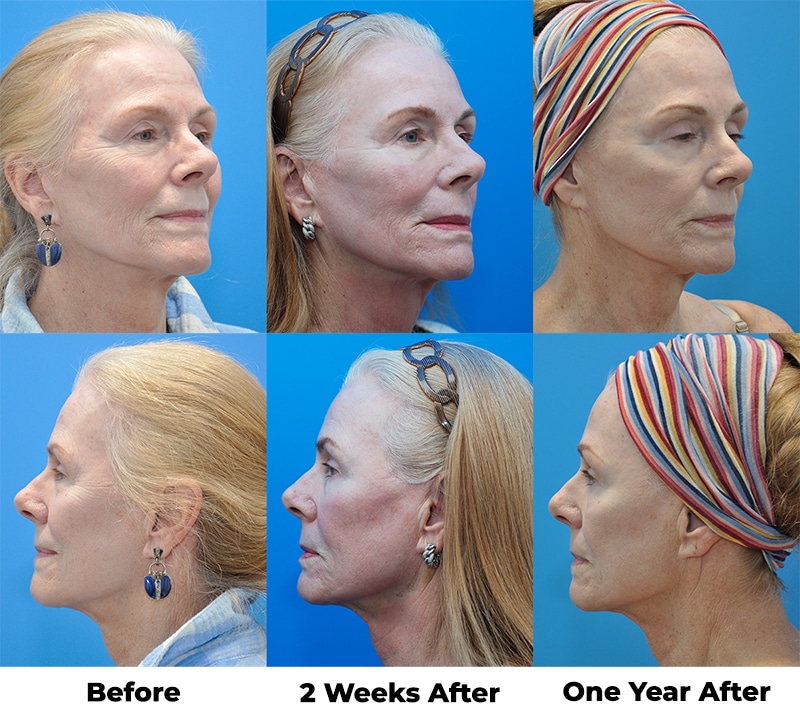 Sculptra Aesthetic in Atlanta Alpharetta GA
