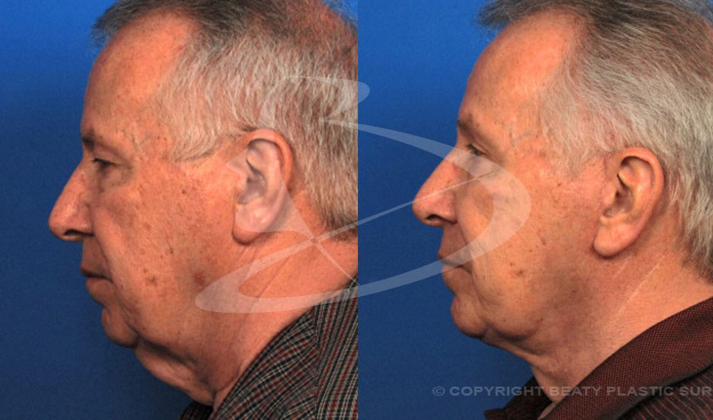 Facial Plastic Surgery Procedures Atlanta Alpharetta GA