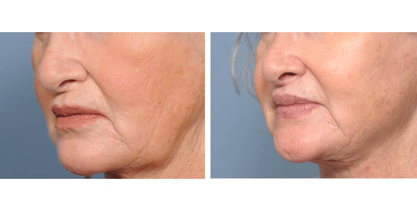 Lip Lift | Lip Surgery | Cosmetic Surgery | Atlanta GA