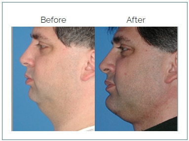 For Men - Beaty Facial PlaFacial Plastic Surgery For Men Atlanta ...