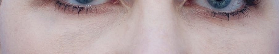 The Melting Midface - Beaty Facial Plastic Surgery