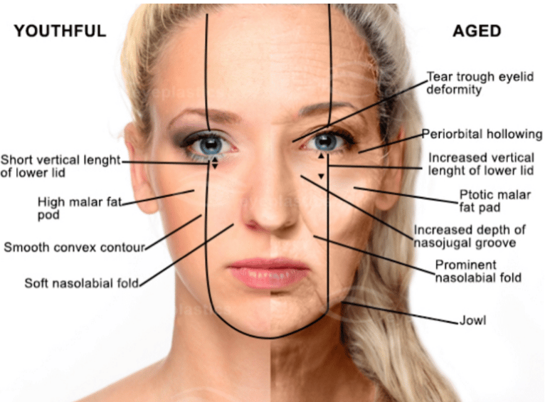 The Melting Midface Beaty Facial Plastic Surgery