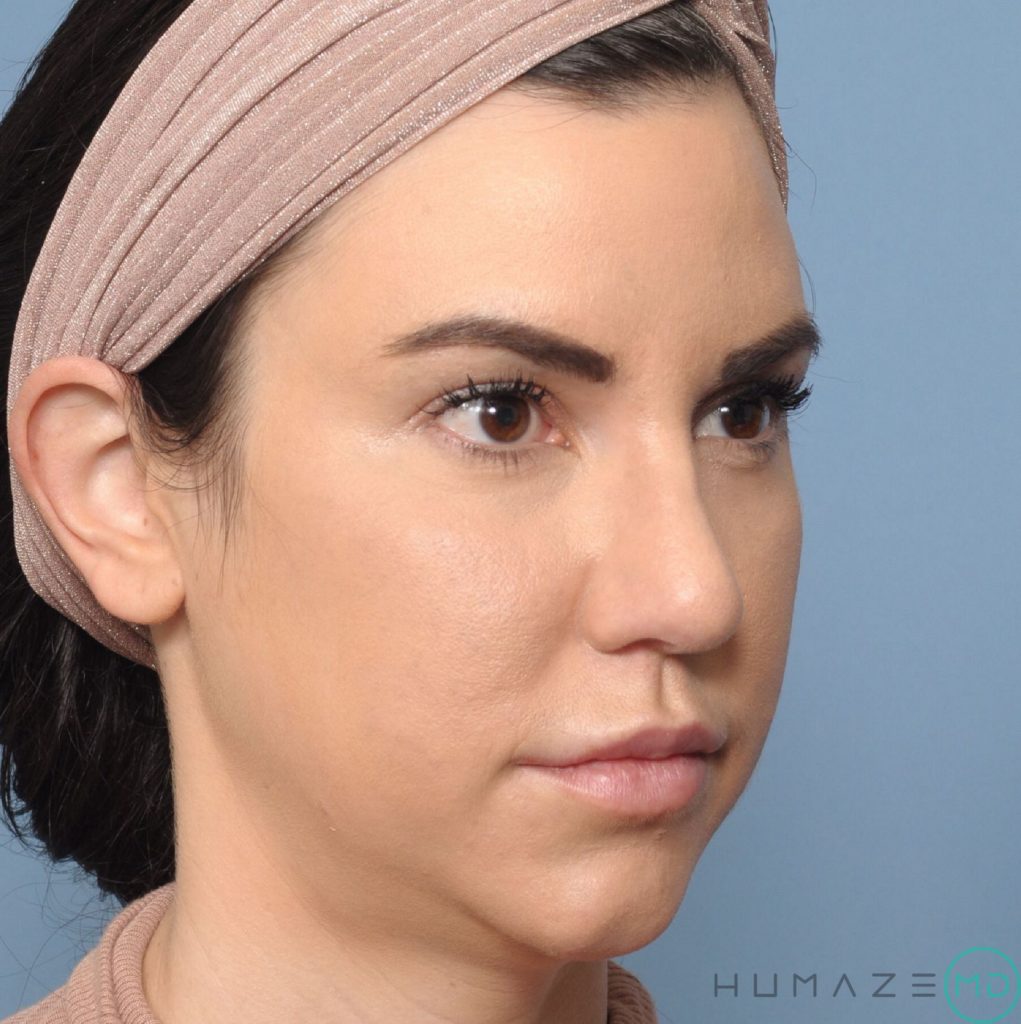 Buccal Fat Removal - Beaty Facial Plastic Surgery