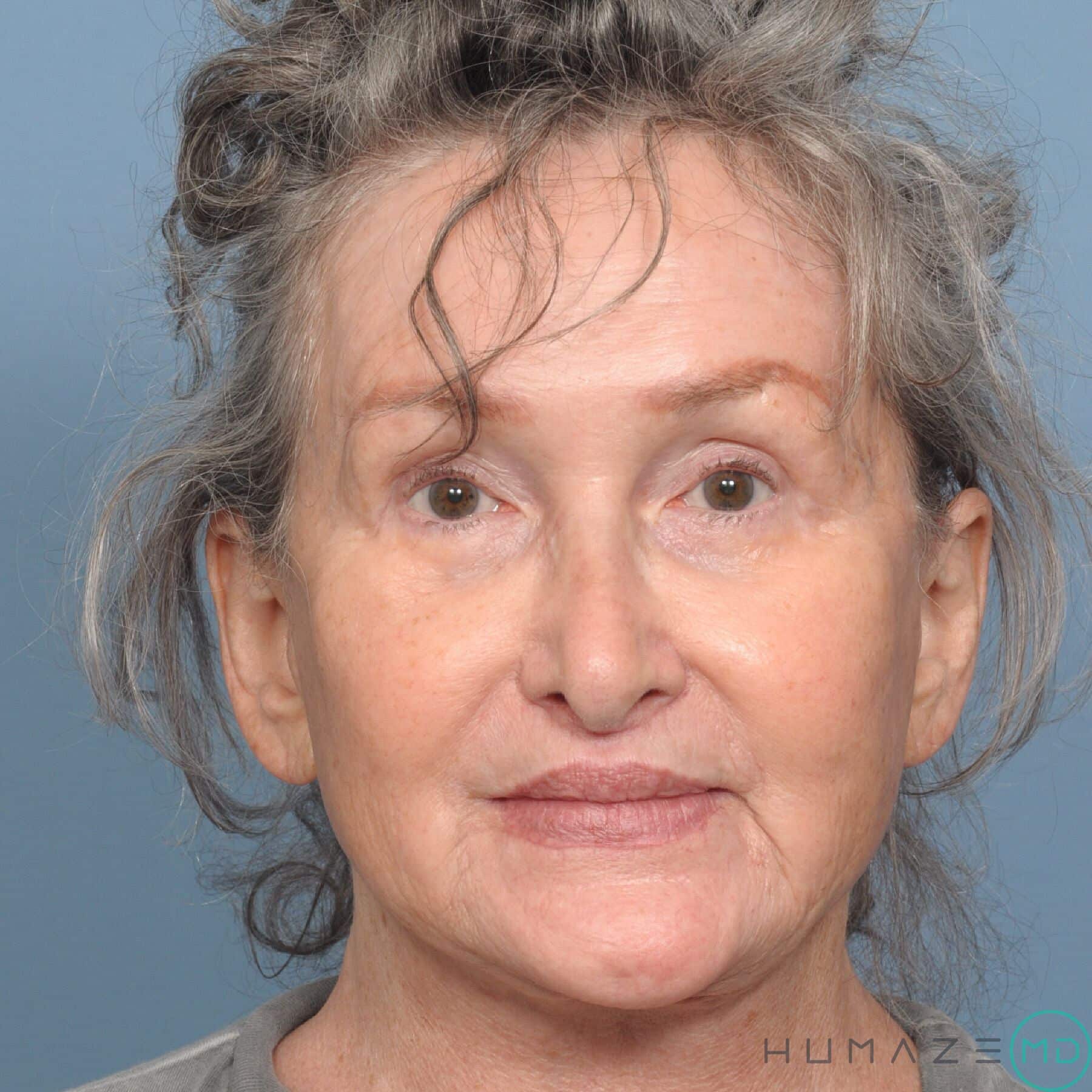 The Melting Midface - Beaty Facial Plastic Surgery