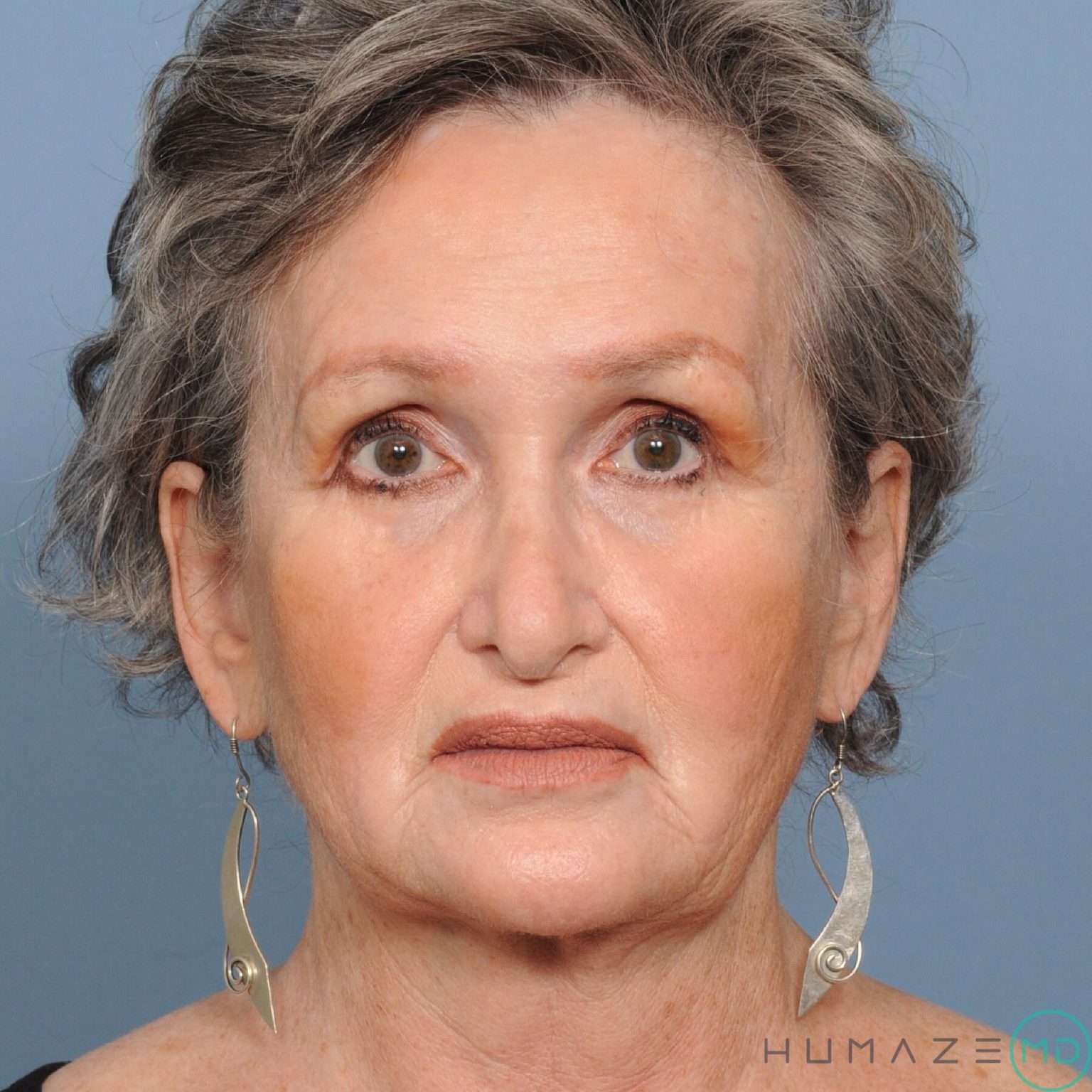 The Melting Midface - Beaty Facial Plastic Surgery