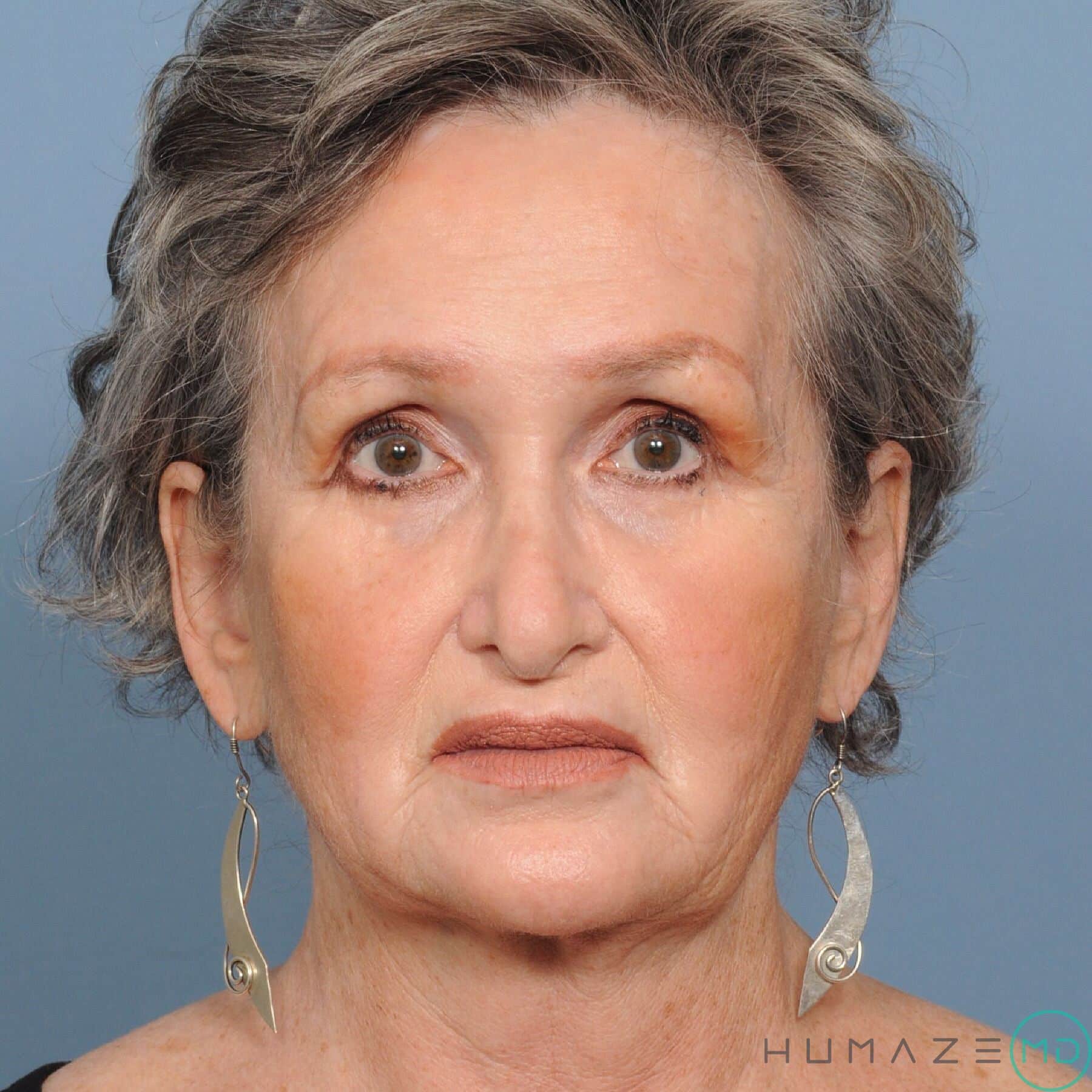 The Melting Midface - Beaty Facial Plastic Surgery