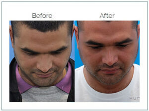 Top Facial Plastic Surgeon Atlanta Alpharetta GA | Dr. Mark Beaty