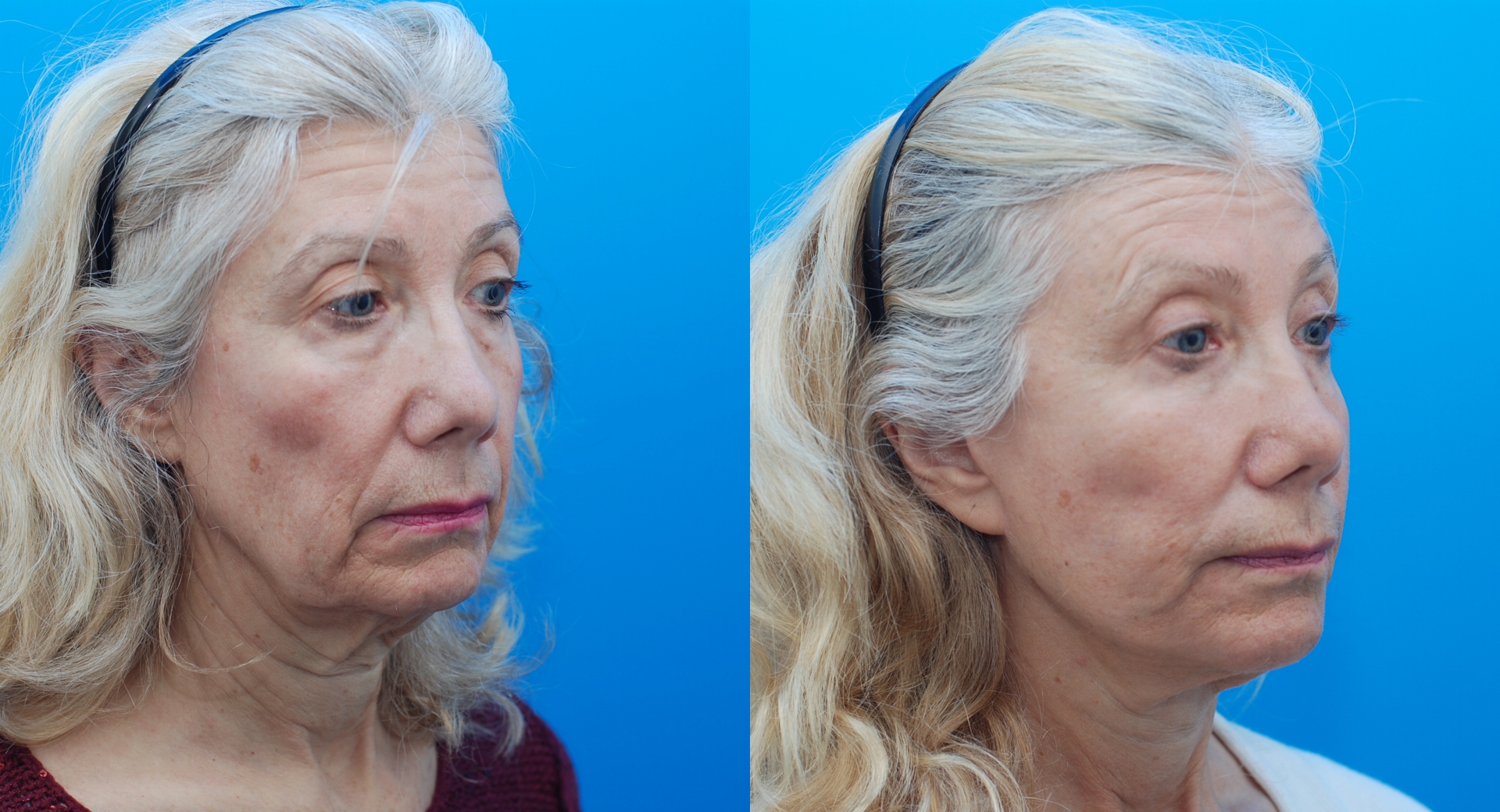 Facelift Surgery in Atlanta Alpharetta GA