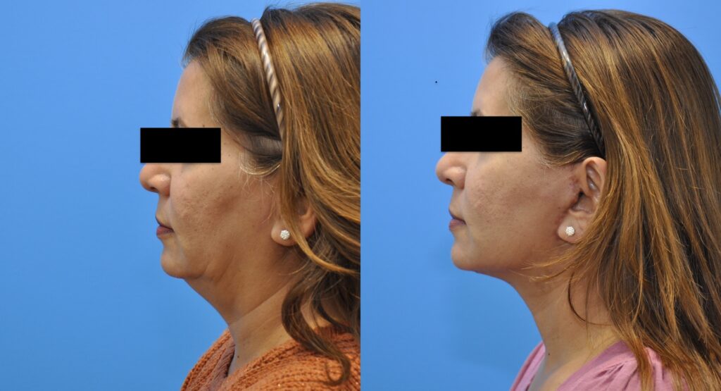 Neck Lift in Atlanta Alpharetta GA
