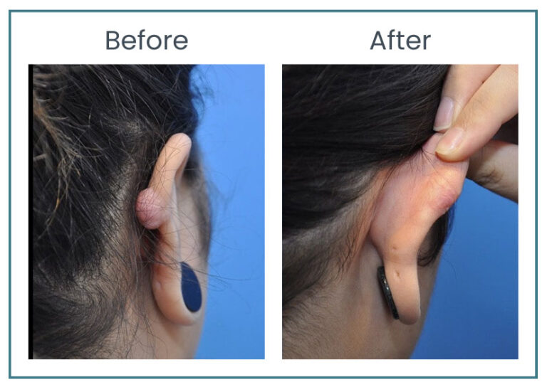 Keloid Scar Removal Atlanta Alpharetta GA