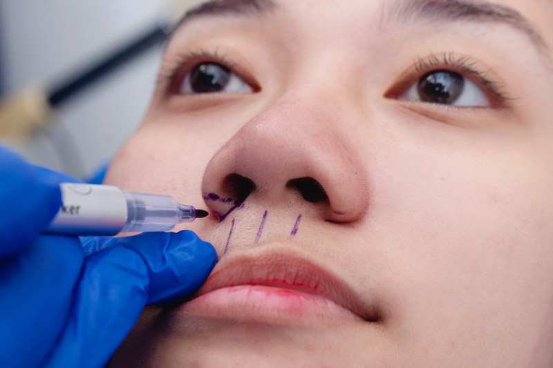 Alarplasty Nostril Reduction Atlanta Alpharetta GA