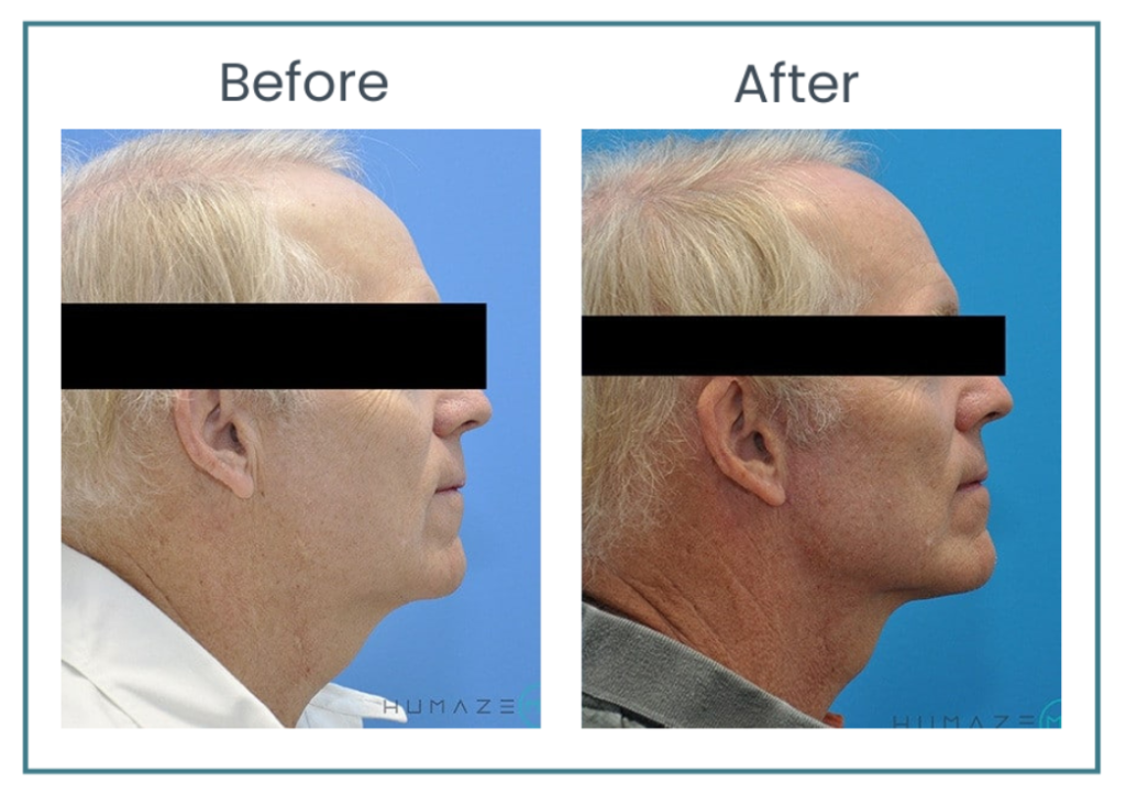 Facial Plastic Surgery Procedures Atlanta Alpharetta GA