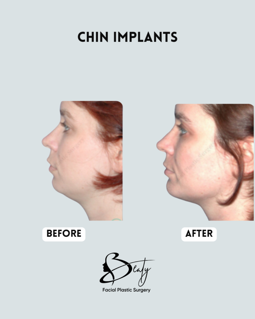 Chin Augmentation 101 - Beaty Facial Plastic Surgery