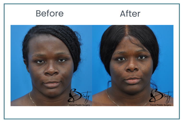 Alarplasty Nostril Reduction Atlanta Alpharetta GA